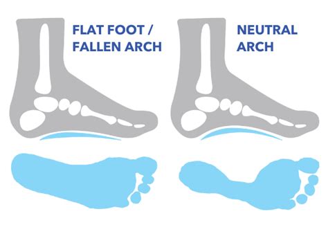 Flat Feet And Fallen Arches Powerstep