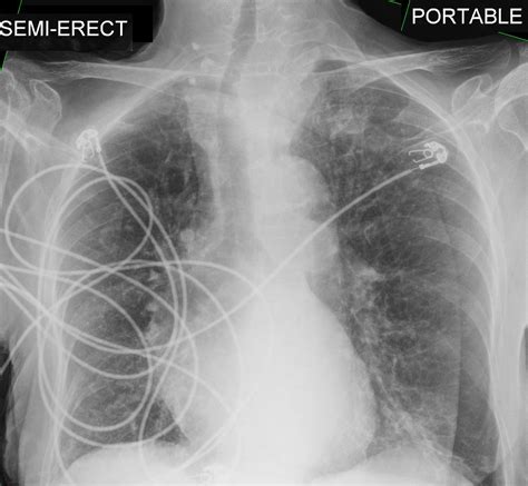 Lungs Pseudopneumothorax Pseudo Ptx Cxr The Common Vein