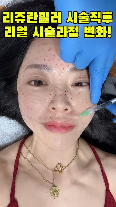 리쥬란힐러 직후 리얼 시술영상 연예인시술 후기 리쥬란힐러 Youtube