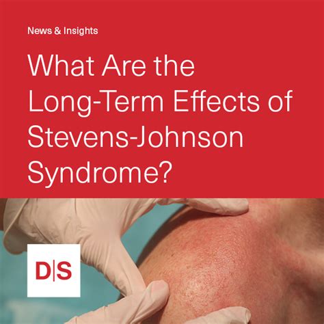 Stevens Johnson Syndrome Signs
