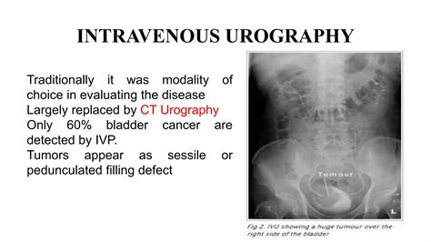 Ca Urinary Bladder Staging And Managment Pptx