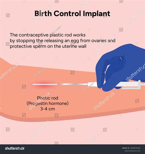 Birth Control Implant Advantages Disadvantages Stock Vector Royalty Free 2558575419 Shutterstock