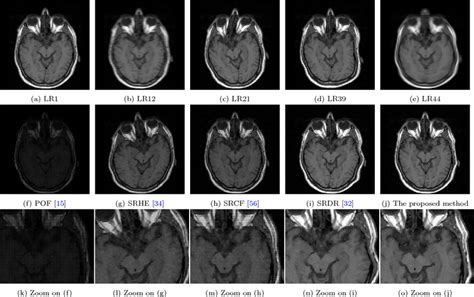 Comparisons Of Reconstructing Mri Brain 1 Image With Different Sr