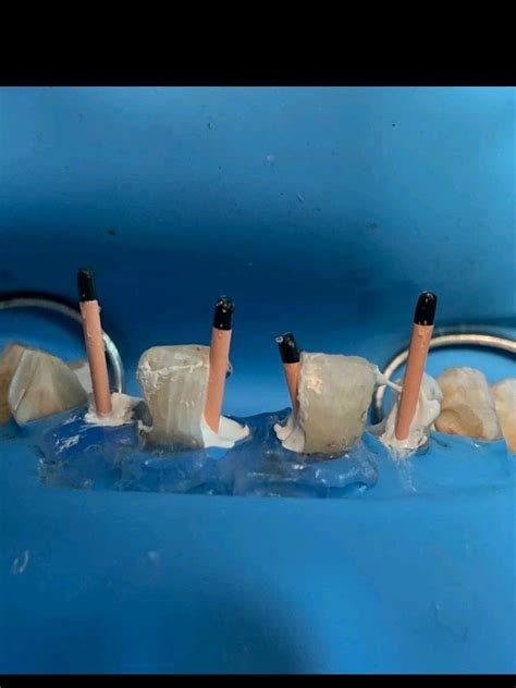 Ebrahim Hassan On Linkedin Single Cone Obturation With Bioceramic Sealer