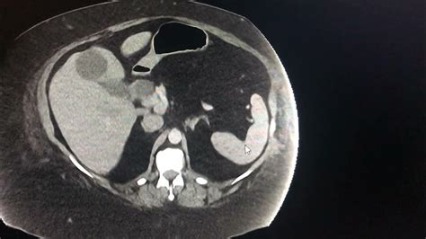 Interesting Case No 23 Cholangiocarcinoma Of Cbd Ct Radarchif Youtube
