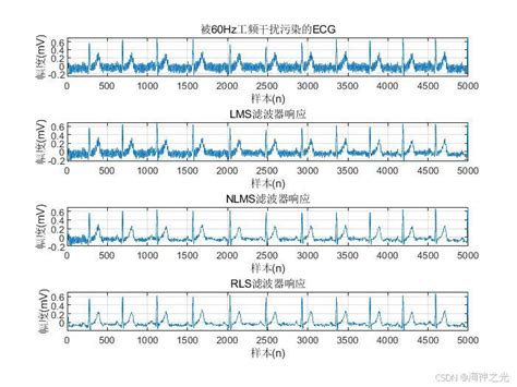 【心电信号ecg】基于matlab自适应lms、nlms和rls心电图噪声消除【含matlab源码 9959期】 自适应心电信号噪声消除算法 matlab csdn博客