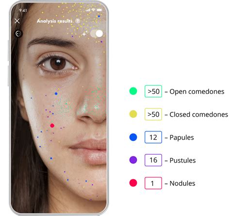 Acne AI