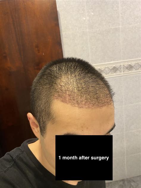 1 Month After Hair Transplant Currently On The Ugly Duck Phase R