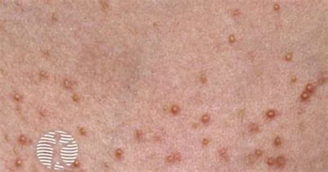 Folliculitis Image