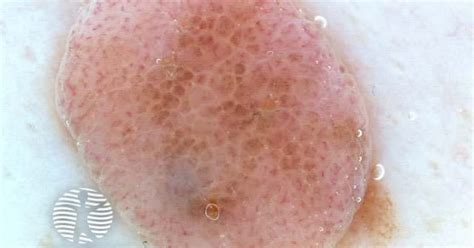 Dermal Naevus Dermoscopy Image