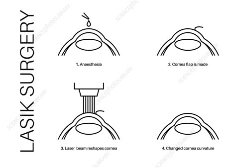 Laser Eye Surgery Illustration Stock Image F0438037 Science