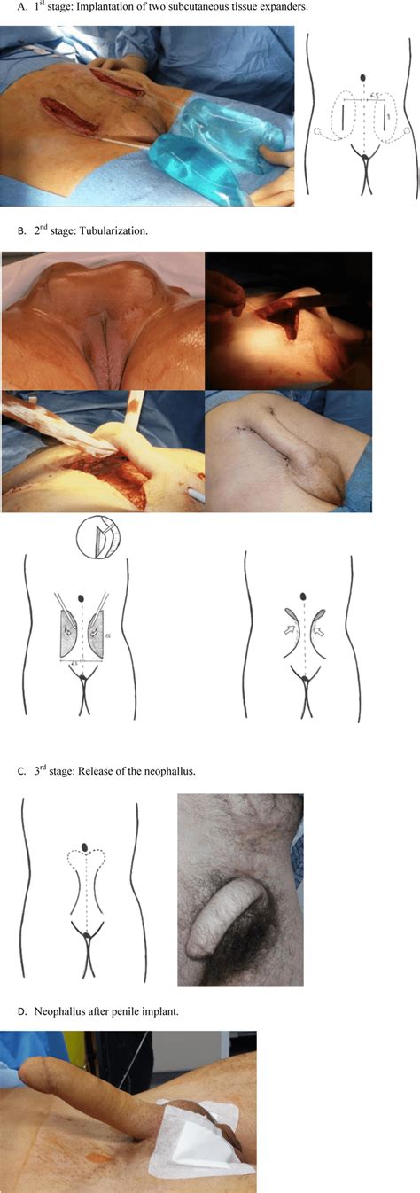 Phalloplasty Before And After Ftm