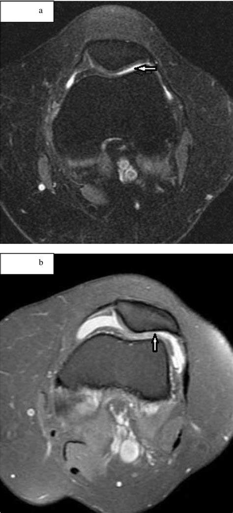 Pdf Relationship Between Trochlear Morphology And Lateral Patellar Cartilage Defect Using Mr