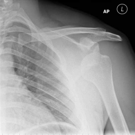 The Stanmore Classification System Of Shoulder Instability Download Scientific Diagram The Stanmore Classification System Of Shoulder Instability Download Scientific Diagram