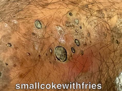 Some Photos I Took Of My Leg Infection Rpopping