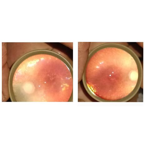 During Preterm Screening Mainly For Rop We Usually Find Many Congenital Muhammad Hatab