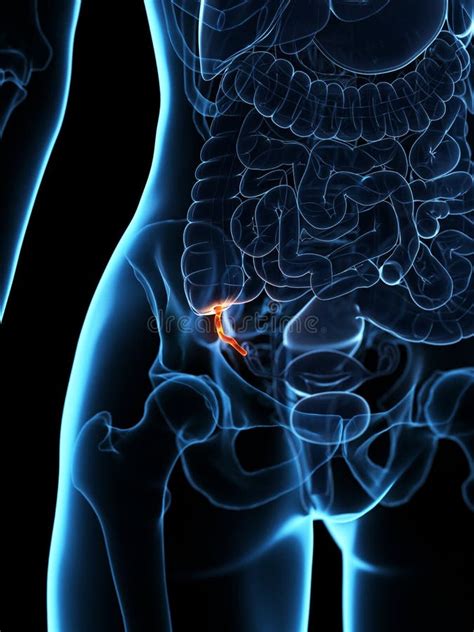 An Inflamed Appendix Stock Illustration Illustration Of Injury