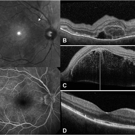 Bilateral Tuberculous Choroiditis Lesion Response To Antituberculous