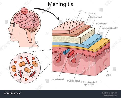 Meningitis Disease Diagram Hand Drawn Schematic Stock Vector Royalty Free 2416873977