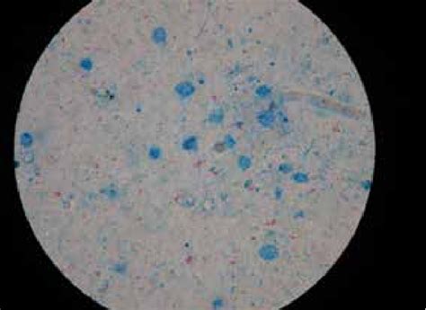 A Light Microscopy Of Zn Stained Smear 1000x Download Scientific