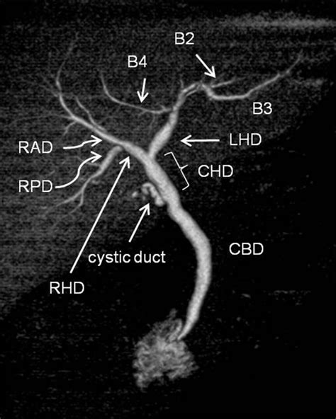 Ct And Mr Cholangiography Advantages And Pitfalls In Perioperative Evaluation Of Biliary Tree
