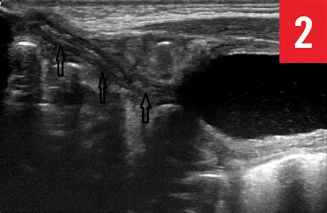 Patent Urachus Consultant360