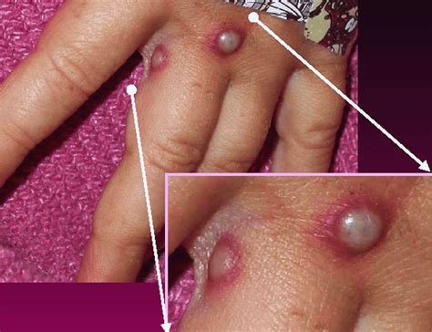 2 Suspected Mpox Case Sa Soccsksargen Binabantayan DOH 12 IBCTV 13