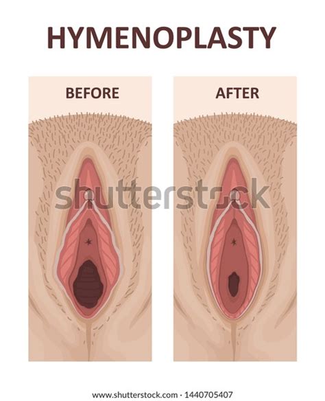 Hymenoplasty Vaginoplasty Hymen Restoration Vector Illustration Stock