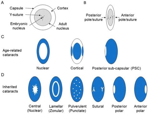 Through The Cat Map Gateway A Brief History Of Cataract Genetics