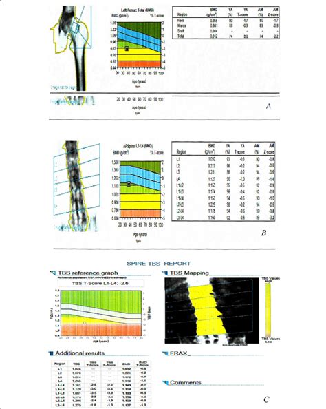 A Single Patient Record Of Dexa Scan A The Decreased Bmd At Hip B
