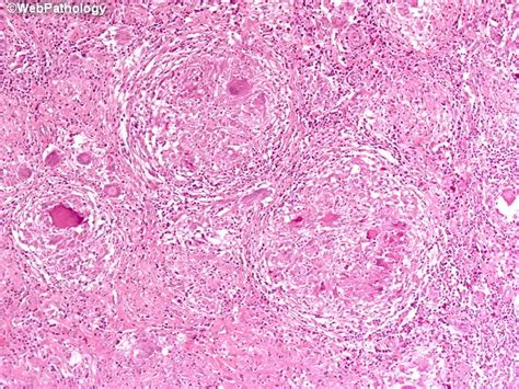 Tuberculous Epididymo Orchitis