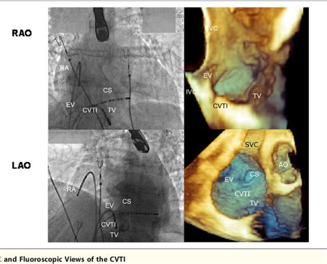Figure 1 From Feasibility And Acute Efficacy Of Radiofrequency Ablation
