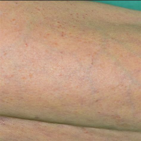Skin Examination Polymorphic Pruritic Rash With Macular Vesicles Download Scientific Diagram