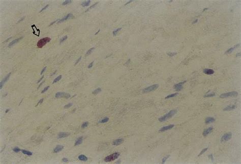 Desmoid Tumor Immunohistochemistry For Cell Proliferation Mild Spindle