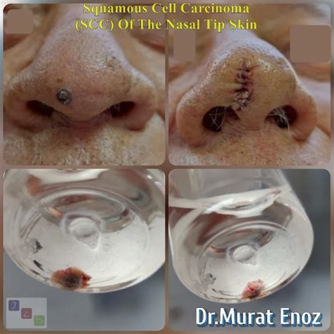 Squamous Cell Carcinoma Scc Of The Nasal Tip Skin