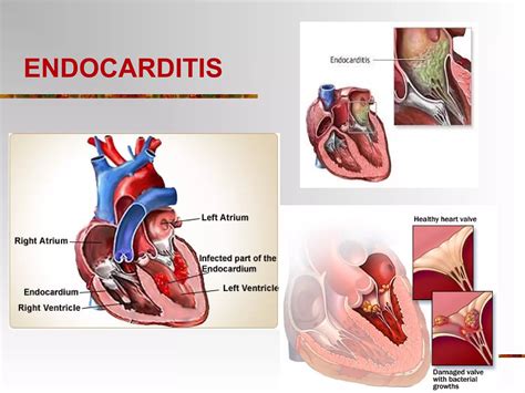 Endocarditis Ppt