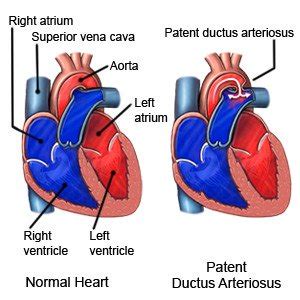 What Is Ductus Arteriosus Quora
