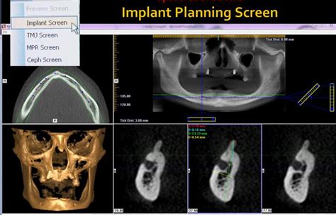 implant planning screen of cbct software download scientific diagram