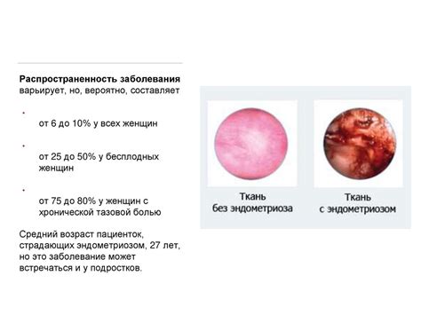 Эндометриозы - презентация онлайн