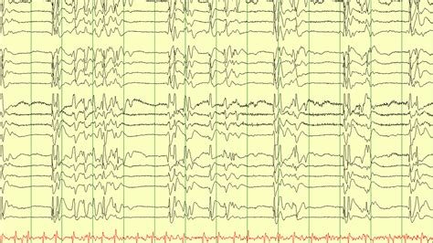eeg and encephalopathy