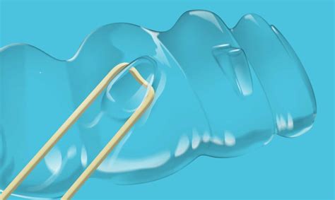 Ormco Vp Breaks Down Spark Clear Aligner Release 13