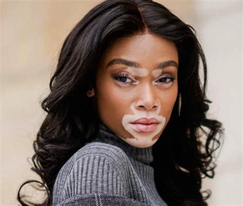 Vitiligo In Teenagers Blog