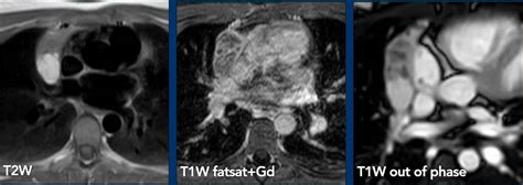 The Radiology Assistant Thymic Masses And Mimics