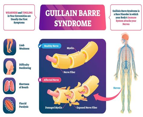 Guillain Barre Syndrome Gbs Explained Causes Symptoms And Treatment