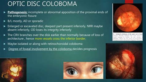 Congenital Optic Disc Anomalies Pptx