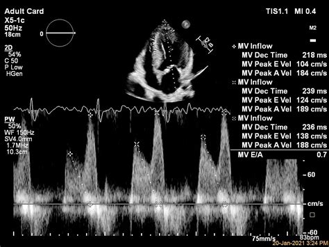 Epiq Cvx Cardiac Ultrasound Philips