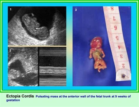 Ectopia Cordis Department Of Obstetrics And Gynecology Faculty Of Medicine Chiang Mai University