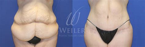 Make The Most Of Your Tummy Tuck Recovery A Timeline Weiler Plastic