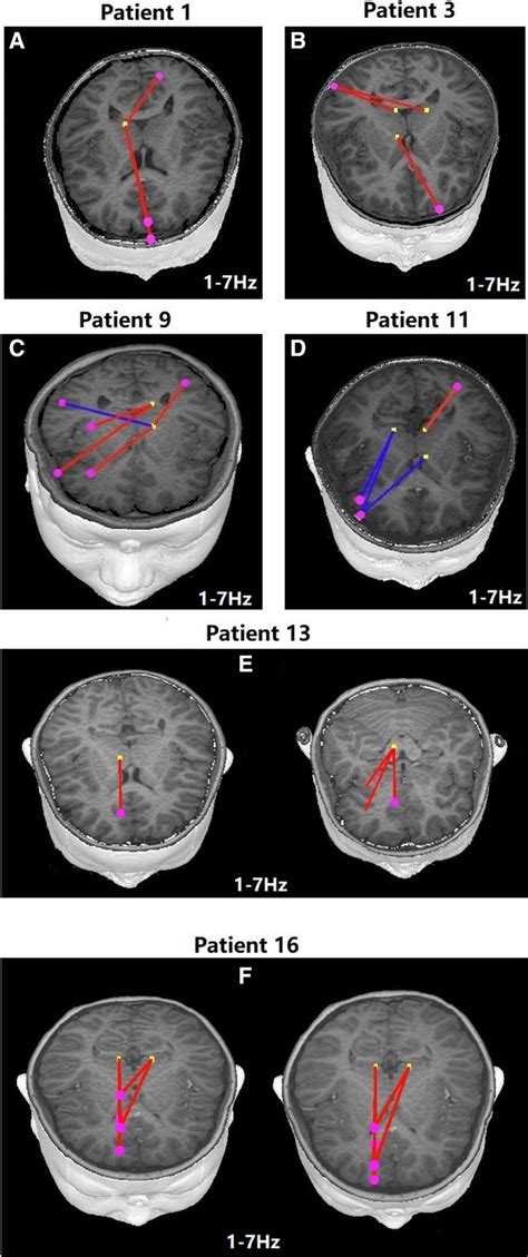 The Frontocorticooccipital Functional Connectivity Fc A
