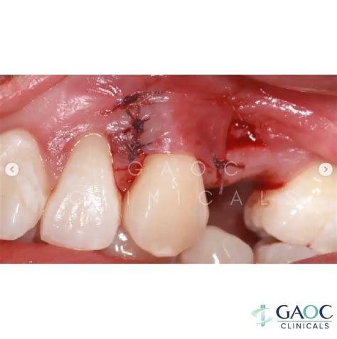 Gingival Recession Gan Advanced Osseointegration Center